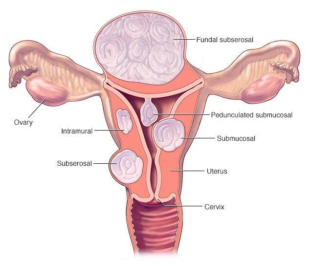 Fibroids Removal Dr Anshumala Shukla Kulkarni